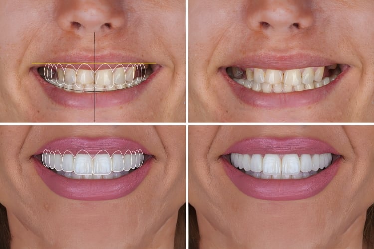 Esthetic vs. Cosmetic Dentistry Explained